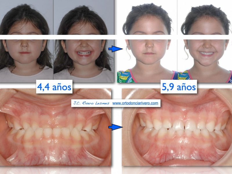 Prognatismo Mandibular: Causas, Síntomas y Tratamiento